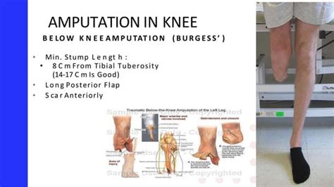 Knee Amputationpptx