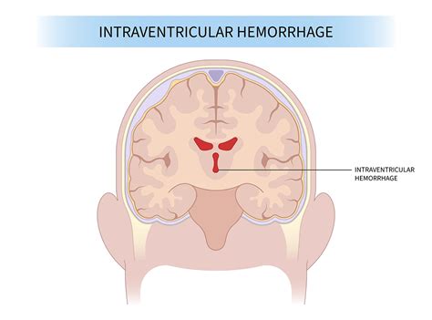 Intraventricular Hemorrhage Aurora Health Care
