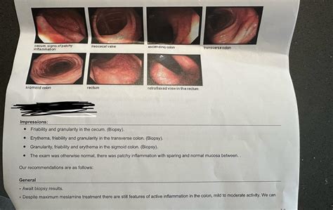 Distal Colitis To Patchy Inflammation R Ulcerativecolitis