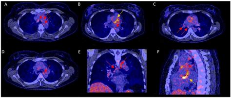 ¹⁸f Fdg Petct Scan With Increased Mediastinal Lymph Node Fdg Activity