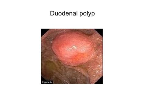 Surgery Stomach And Duodenum Tg