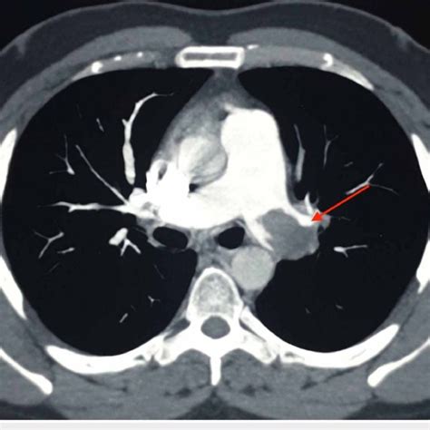Axial Section Of Ctpa Scan Showing Reduction In The Size Of The Filling