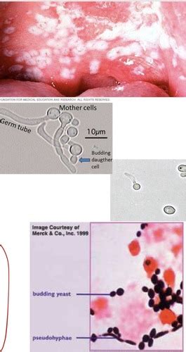 Infections Of Oral Cavity Salivary Glands Esophagus Stomach Flashcards Quizlet