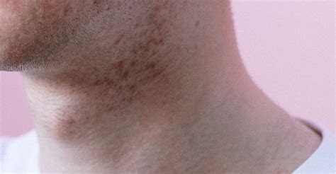 Significato Dei Brufoli Sul Viso Cosa Dicono Della Tua Salute