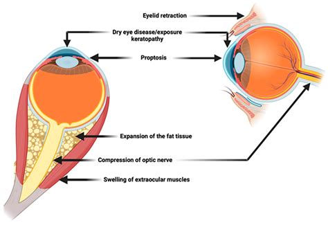 Thyroid Eye Disease Advancements In Orbital And Ocular Pathology