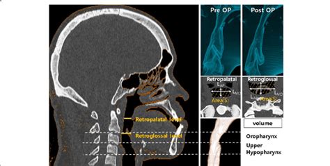 Measurements In Volume Linear Distance And Area In The Pharyngeal