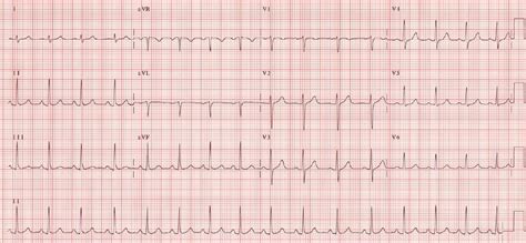 ECG Quiz Can You Work Out The Heart Rate From A Printout Pulse Today