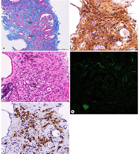 Renal Biopsy Findings A Normal Glomeruli And Storiform Fibrosis Which
