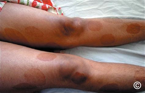 Dermatitis Artefacta