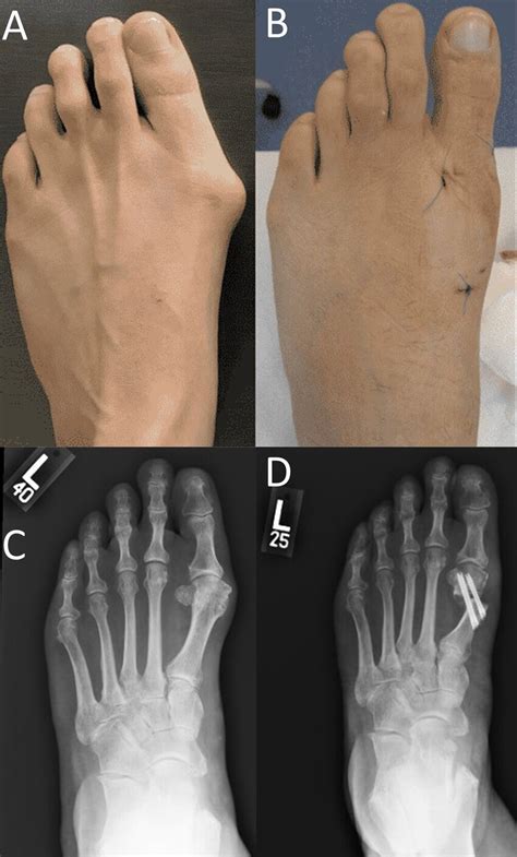 A Preoperative Appearance Of A Patient With Hallux Valgus Deformity Download Scientific