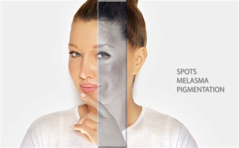 Understanding Different Types Of Pigmentation And How To Treat Them