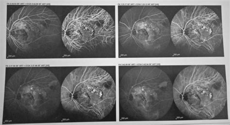 Ffaicga Of Left Eye Of The Same Patient As In Fig 1 Showing Upper Download Scientific