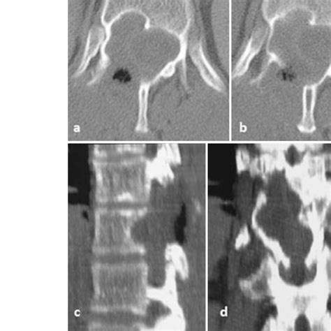 Postoperative Axial Ct A B Sagittal Reconstructed Ct C And