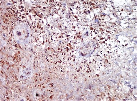 Anaplastic Lymphoma Kinase Positive Primary Cutaneous Anaplastic Large