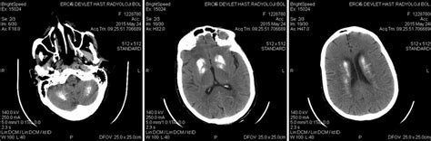 Ct Scan Showing Bilateral Symmetric Calcifications On Bilateral Basal