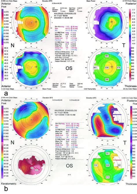 Corneal Topography Of The Left Eye At Presentation With Normal Findings