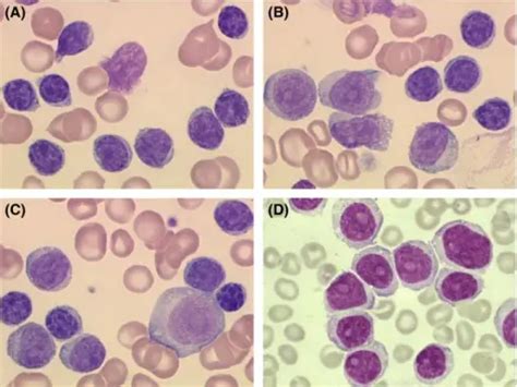 What Is Chronic Lymphocytic Leukemiasmall Lymphocytic Lymphoma