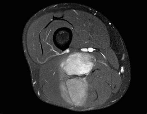Liposarcoma Mixoide Oncocirugia