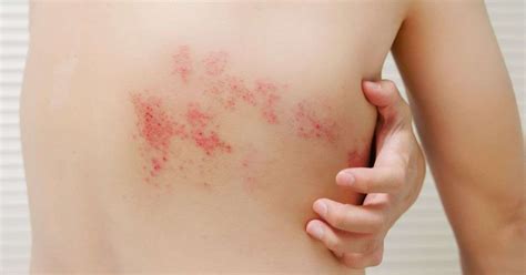 Shingles Diagnosis And Treatment In Fort Lauderdale
