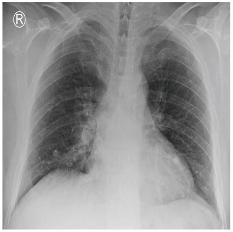 Covid Detection Using Chest X Ray At Maria Couch Blog