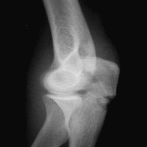 Management Of Comminuted Olecranon Fractures With Precut K W Techniques In Hand And Upper