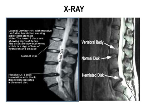 Herniated Nucleus Pulposus Ppt