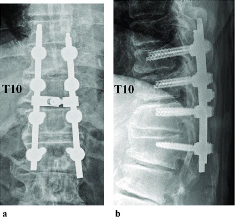 Postoperative Radiograph After Posterior Decompression Followed By