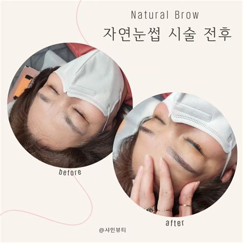 샤인뷰티 유륜색소침착 르멜라 시술 1회 3주 케어크림 변화 실제 르멜라 임상자료 입니다 무단도용 복제시 불이익을 받으실 수 있습니다 ∙반영구문신이 아닌