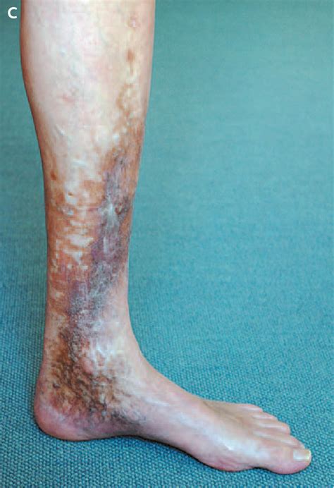 Stasis Dermatitis Amboss Rotation Prep