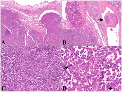 Pathological Findings Of Glomus Tumor Hematoxylin And Eosin A The