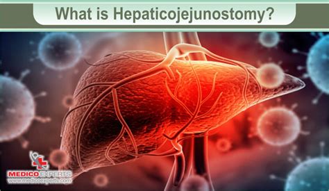Hepaticojejunostomy Surgery Your Key To A Healthier Liver