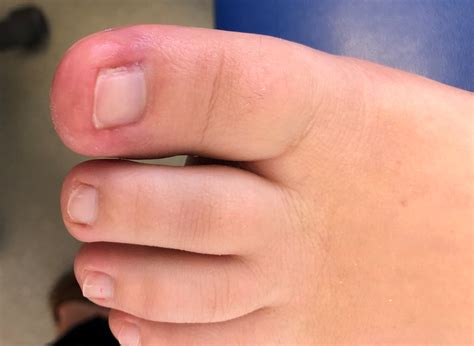Ingrown Toenails Treatment And Aftercare Sussex Foot Centre