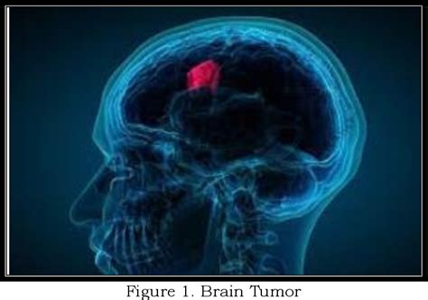 Figure 1 From Brain Tumor Identification And Tracking Using Image Processing Technique