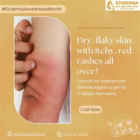 Ppt Having Dry Flaky Skin With Itchy Skin Clinic In Jayanagar