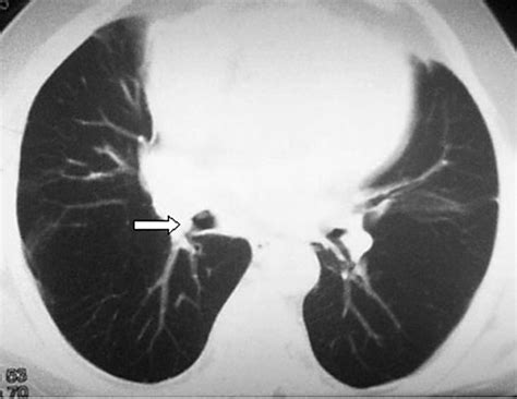 Resection Of Endobronchial Hamartoma Causing Recurrent Hemoptysis By