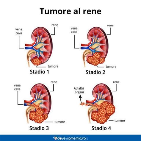 Stadi Del Cancro Del Rene