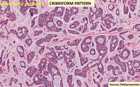 Cribriform Pattern Patternsinhistopathology Pathology Made Simple