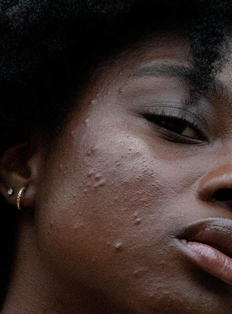 A Beauty Expert On How To Approach Acne And More In 2024