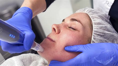 Skinpen Microneedling SkinCity Huidkliniek