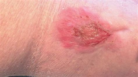 Ulcus Cruris Arteriosum Diagnose Und Wundversorgung