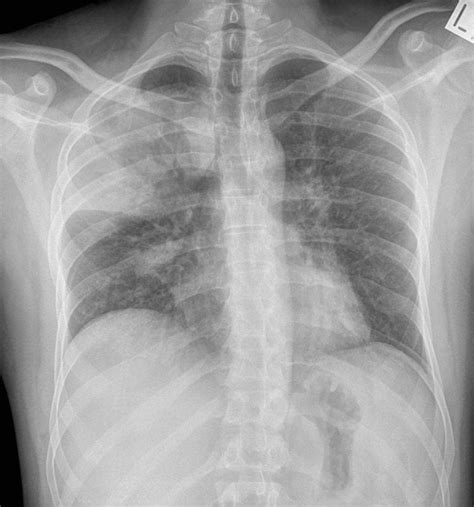 CXR Case LITFL Chest X Ray Self Assessment Quiz