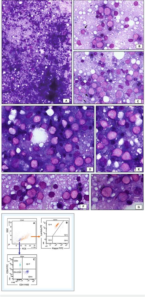 JLE Annales de Biologie Clinique Diagnostic des lymphomes leçons tirées de la comparaison