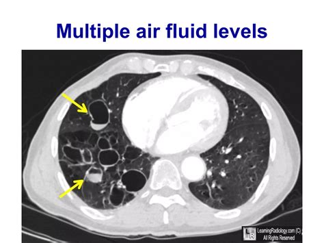 Bronchiectasis Ppt