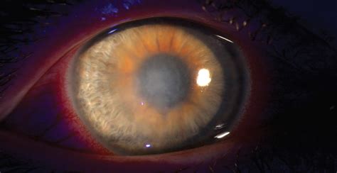 A Primer On Herpes Simplex Keratitis Modern Optometry