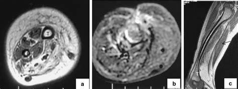 Response To Treatment On Mri Follow Up Mri Shows Resolution Of Download Scientific Diagram
