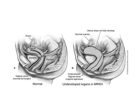 Congenital Abnormalities Of Reproductive System Pptx