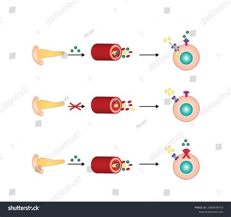 Diabetes Mellitus Type 1 Pancreass Failure Stock Vector Royalty Free