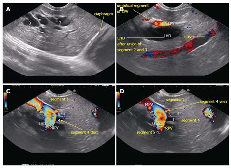 Common Bile Duct Ultrasound