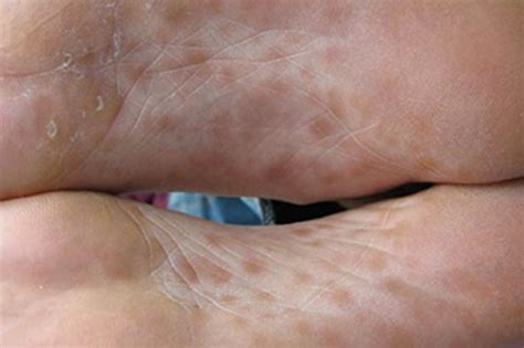 女性得梅毒症状图片（最新19张）高清图片大全