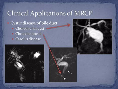 Magnetic Resonance Cholangiopancreatography Mrcp Pptx